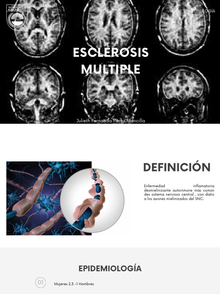 Esclerosis Múltiple: Definición y Tratamiento | PDF | Esclerosis ...