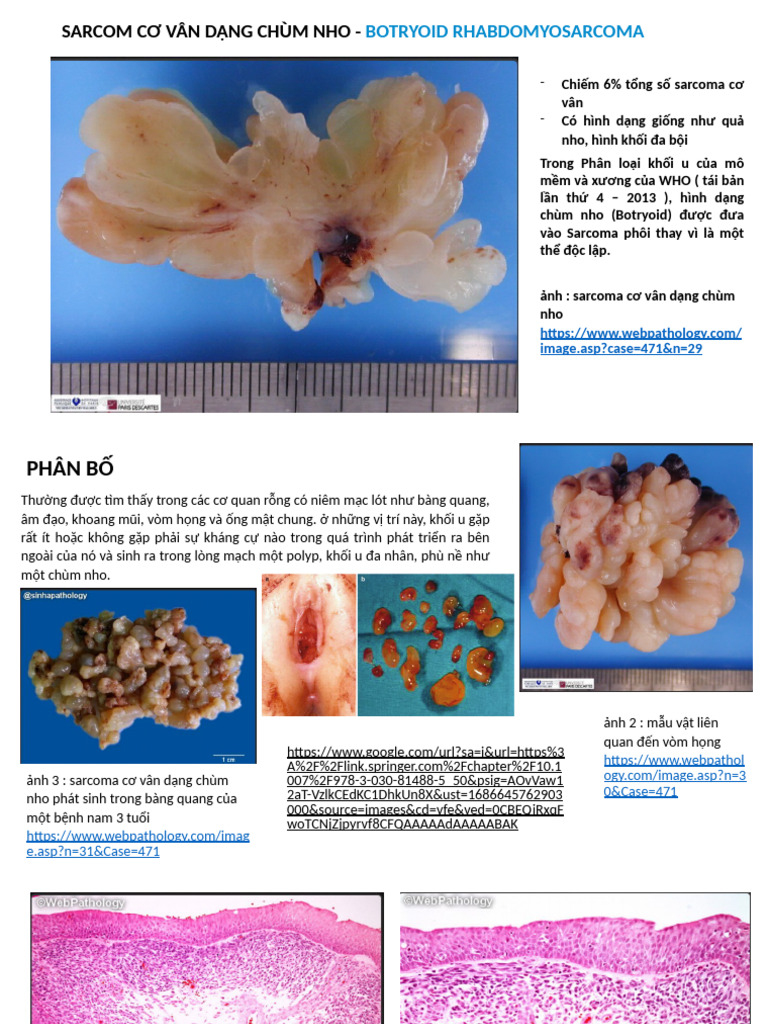 SARCOMA CƠ VÂN DẠNG CHÙM NHO | PDF