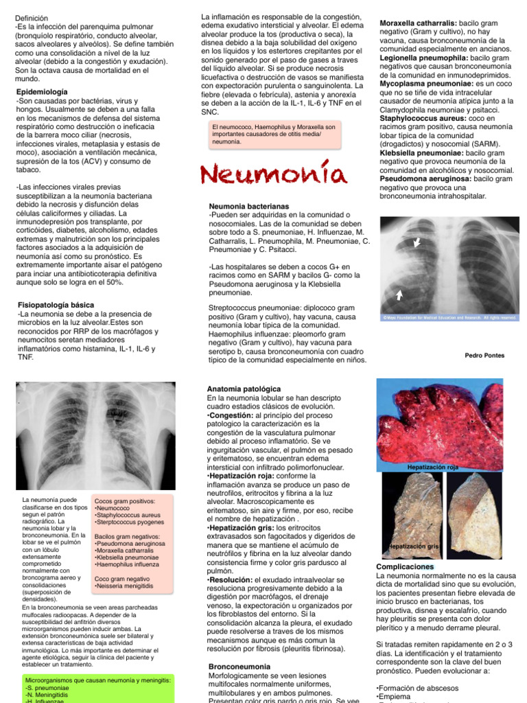 3 - Neumonía | PDF | Neumonía | Influenza