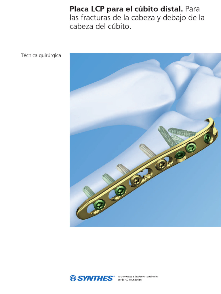 Placa LCP para Fracturas del Cúbito Distal | PDF | Tornillo