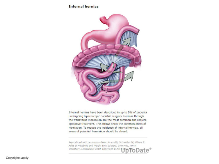 Hernie Interne | PDF
