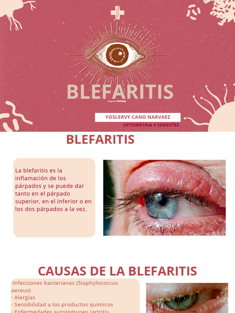 blefaritis | PDF