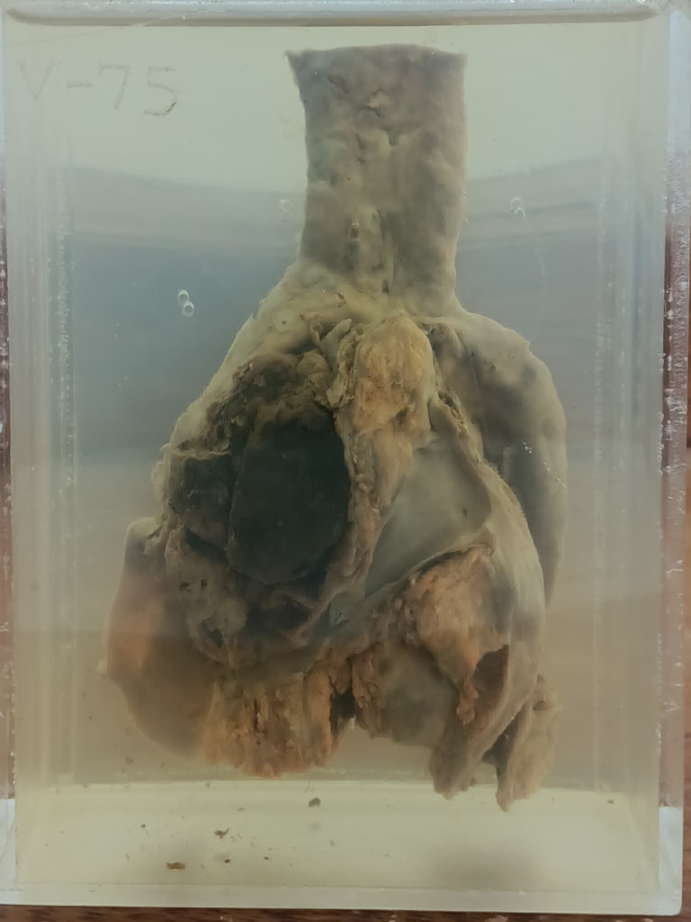 Blood Vessel Diseases | PDF