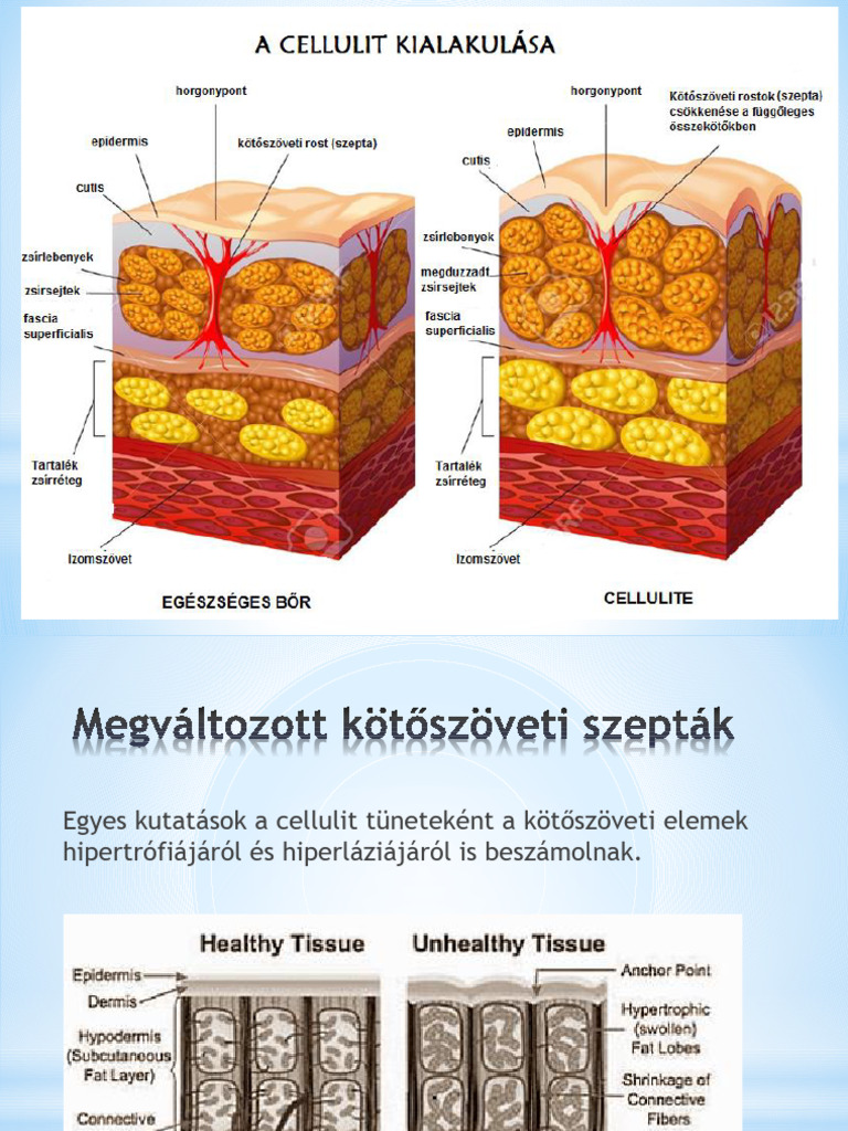 Cellulit 25 | PDF