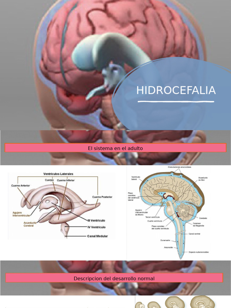 Hidrocefalia (EMBRIO) | PDF