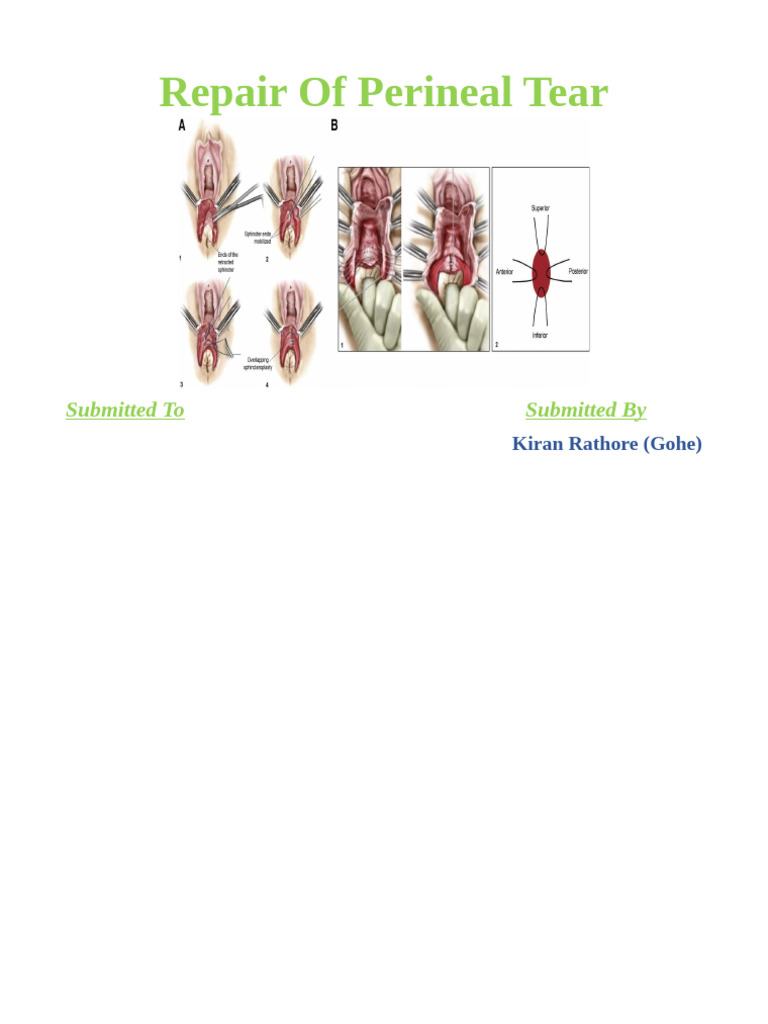 Repair of Perineal Tear | PDF