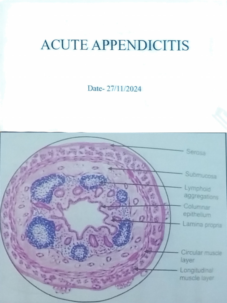 Acute Appendicitis | PDF