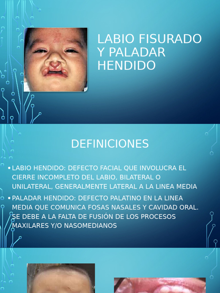 Labio Fisurado y Paladar Hendido Clase | PDF | Especialidades Medicas ...