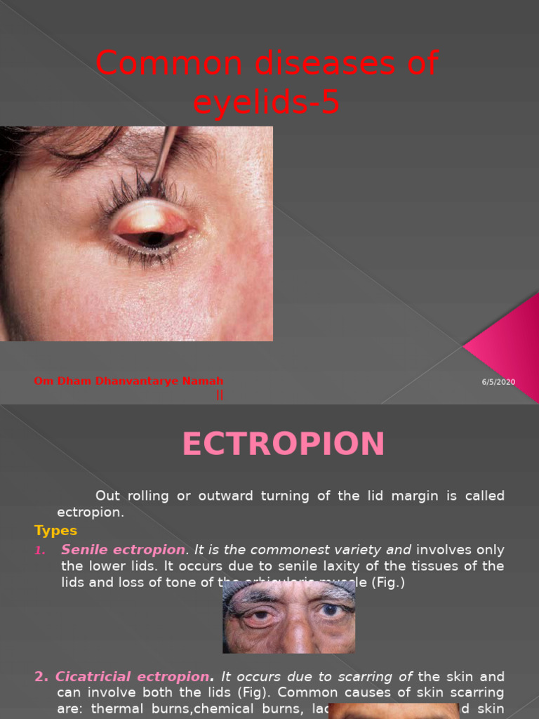 Ectropion: Types, Symptoms, and Treatment | PDF | Scar | Diseases And ...