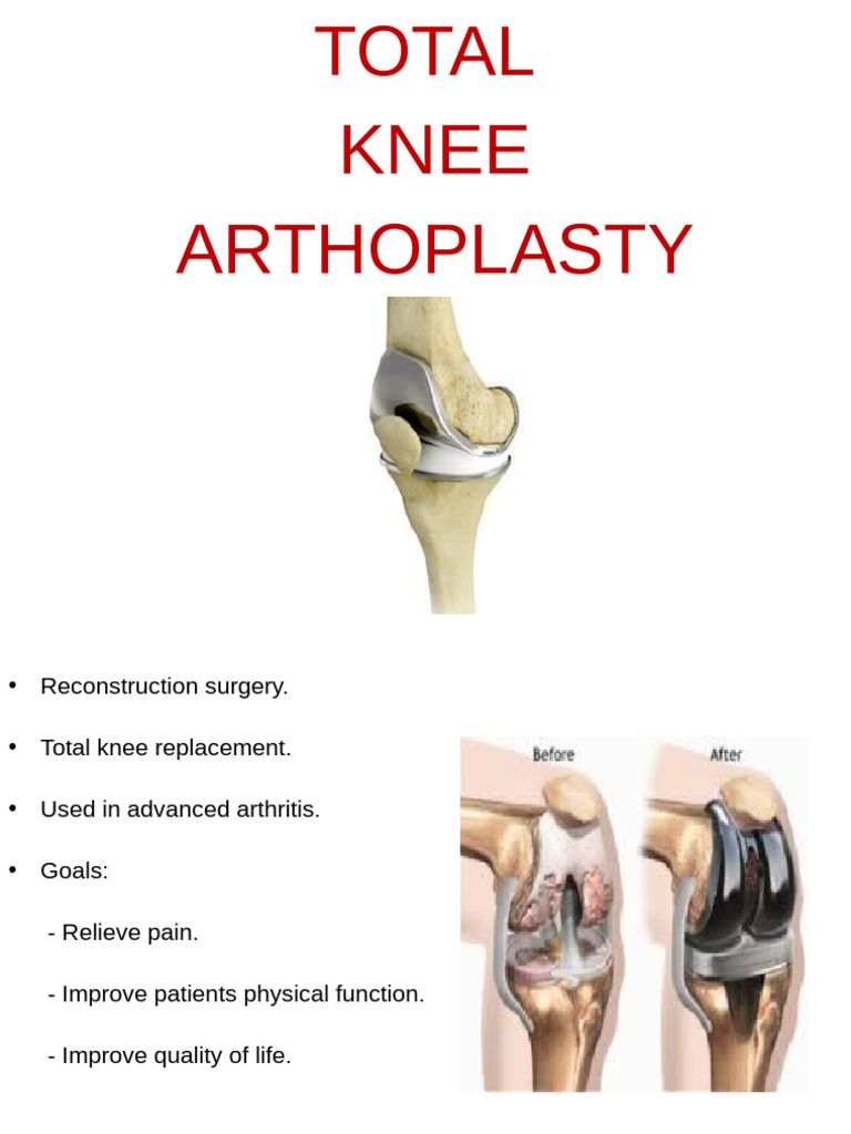 Total Knee Arthroplasty Overview | PDF | Knee | Musculoskeletal System