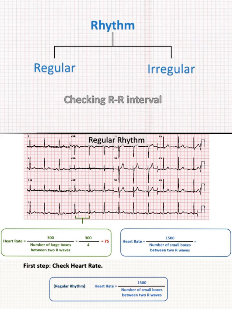 ECG Quick Rev | PDF