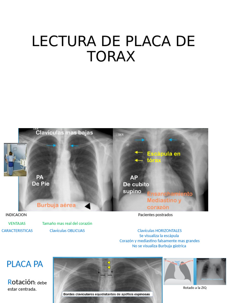 Lectura de Placa de Torax | PDF | Tórax | Aorta