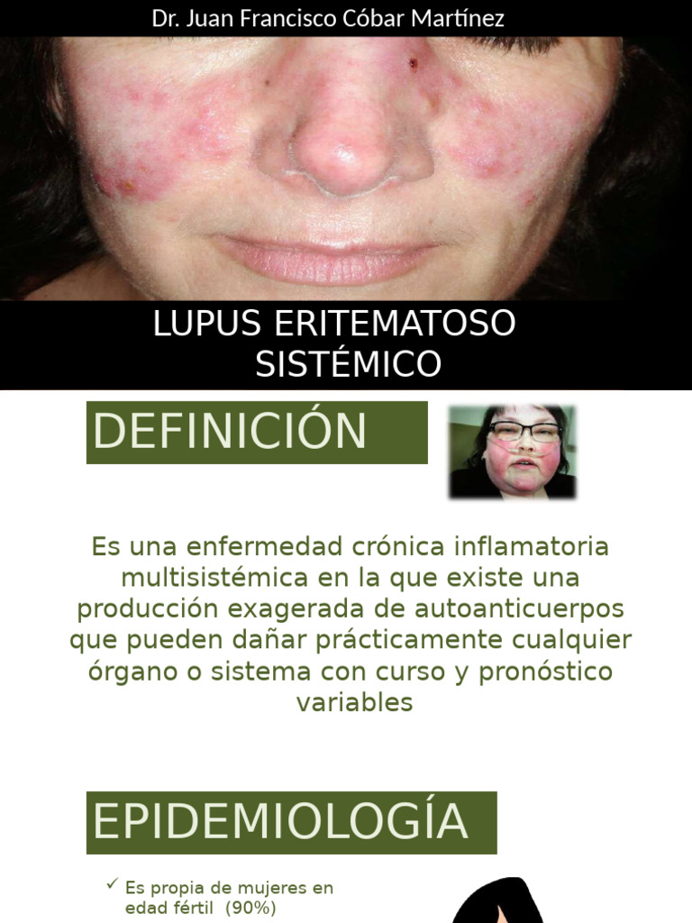 Lupus Eritematoso Sistémico | PDF | Medicina CLINICA | Inmunología
