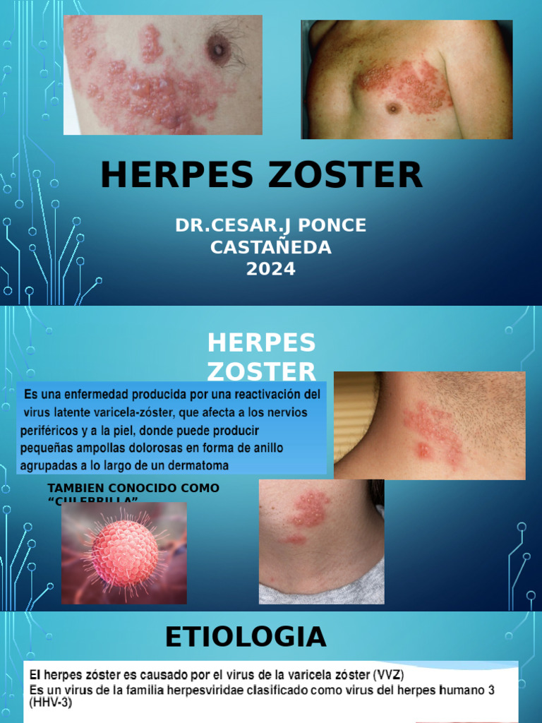 (6) HERPES ZOSTER CPC_241128_154702 | PDF
