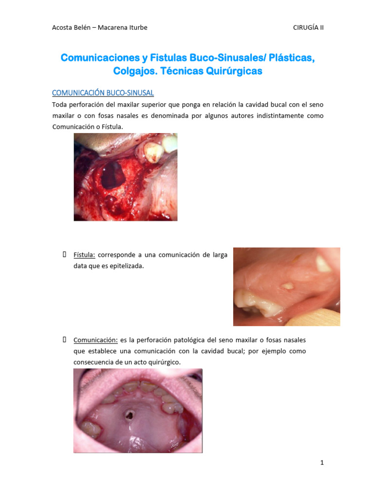Técnicas Quirúrgicas en Fístulas Buco-Sinusales | PDF | Nariz humana