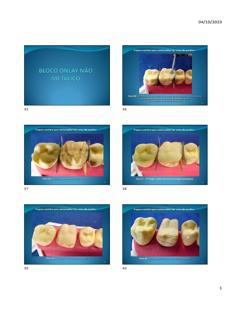 preparo para bloco onlay ceramico | PDF