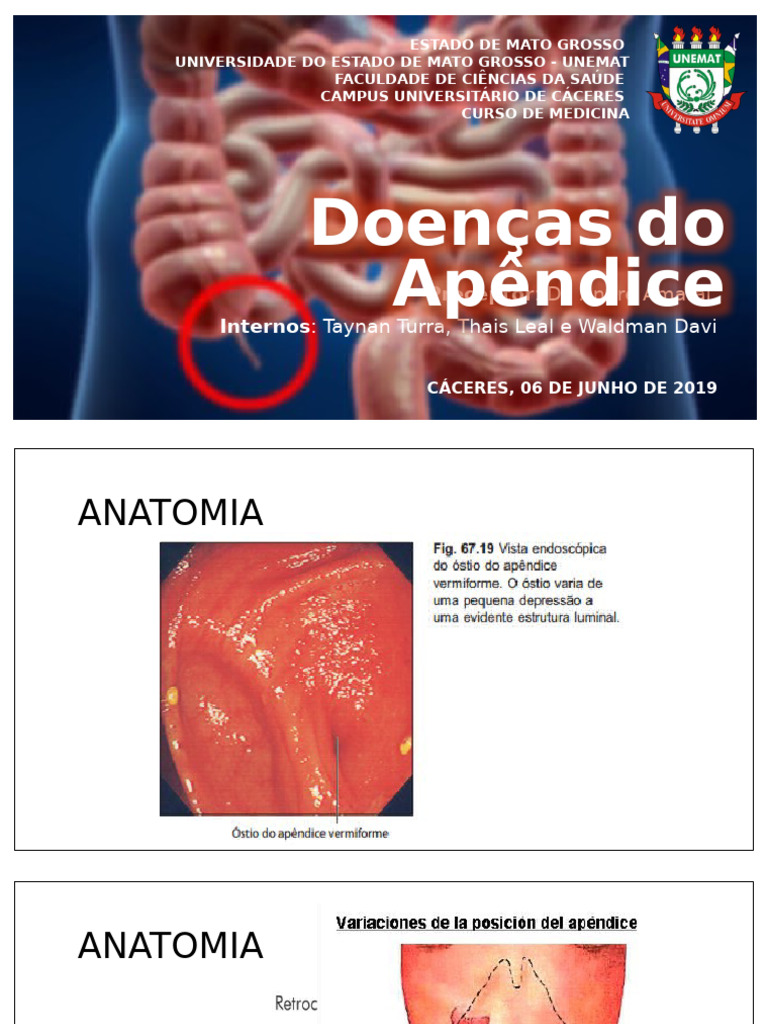 Apendicite Aguda: Diagnóstico e Tratamento | PDF | Doenças e distúrbios ...