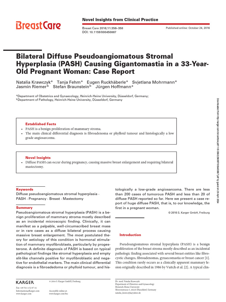 Bilateral Diffuse Pseudoangiomatous Stromal Hyperplasia (PASH) Causing ...