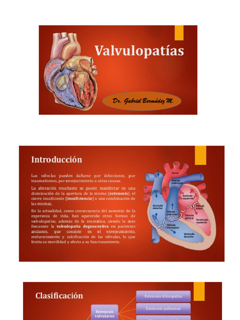 Signos y Tratamiento de Insuficiencia Aórtica | PDF