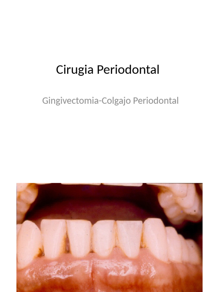 Colgajos Periodontales | PDF