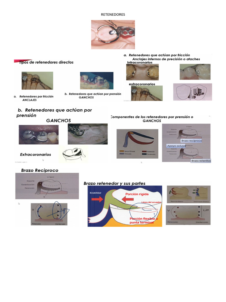 Retenedores y Línea de Fulcro | PDF
