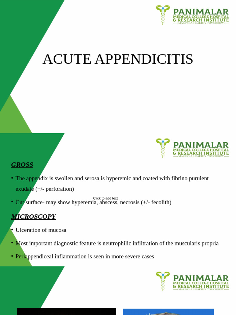 Acute Appendicitis | PDF