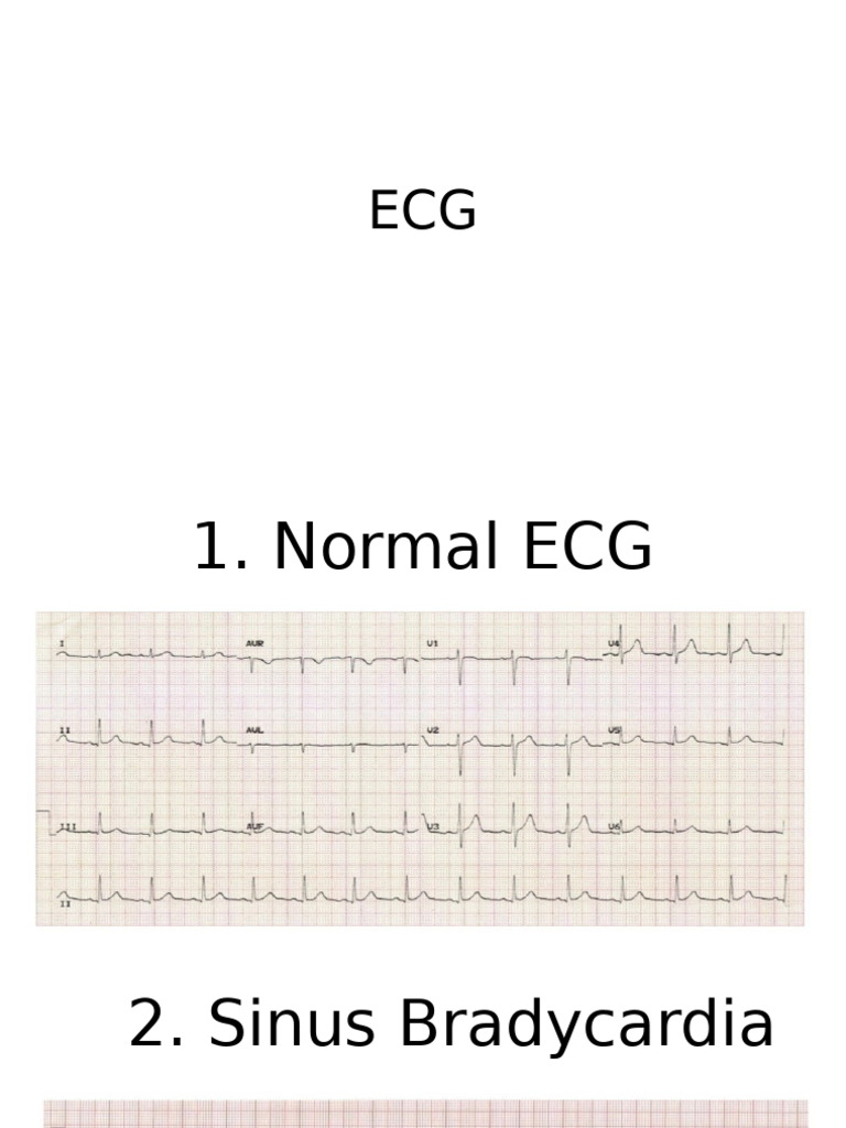 Ecg | PDF