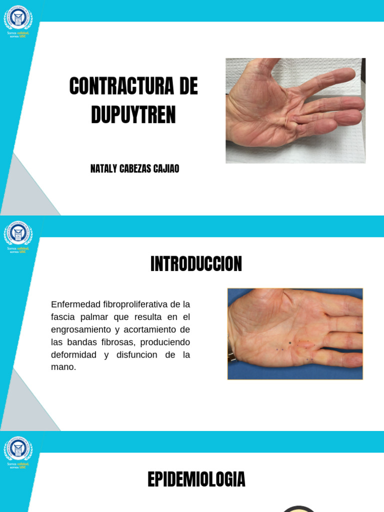 Contractura de Dupuytren: Síntomas y Tratamiento | PDF | Medicina ...