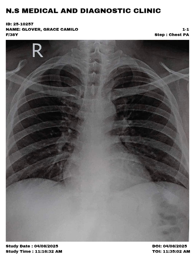 Xray Grace - 20250404 - 170240 - 0000 | PDF