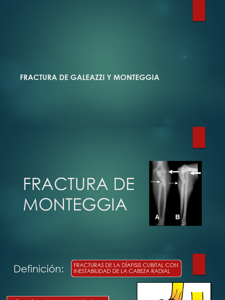Fracturas de Monteggia y Gallazzi | PDF | Codo | Enfermedades y trastornos