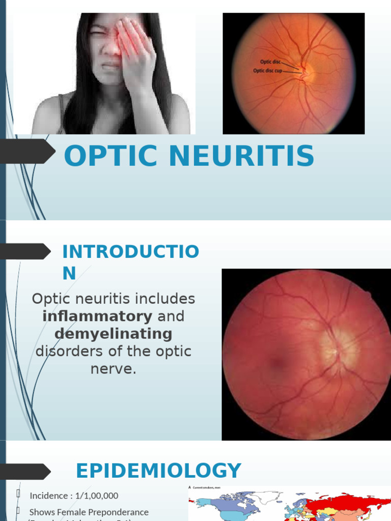 OPTIC NEURITIS Shashank | PDF | Multiple Sclerosis | Immunology