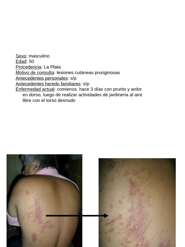 Caso Fitofotodermatosis | PDF