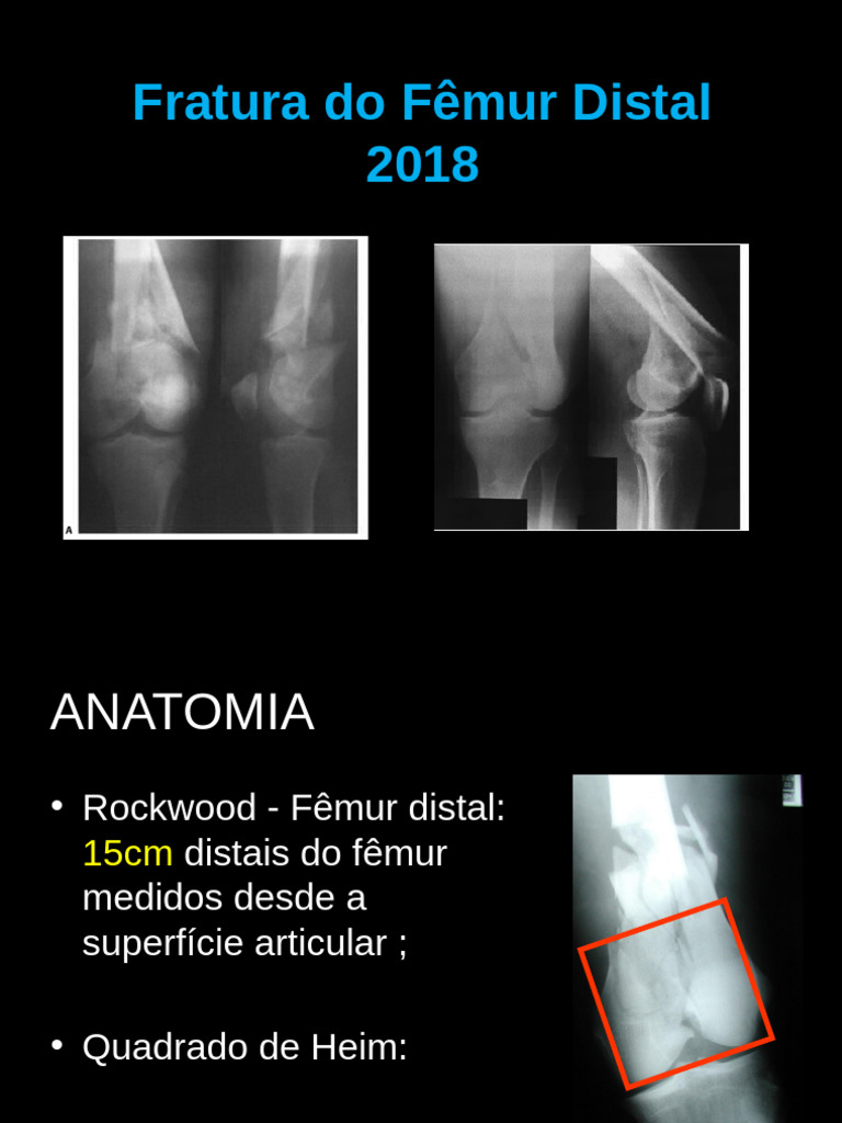 Fratura Fêmur Distal 2019 | PDF | Joelho | Sistema Locomotor