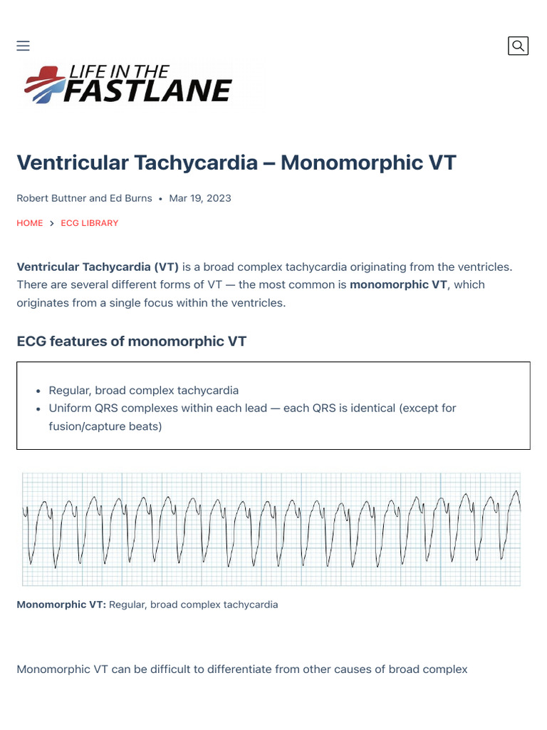 Ventricular Tachycardia - Monomorphic VT - LITFL | PDF ...