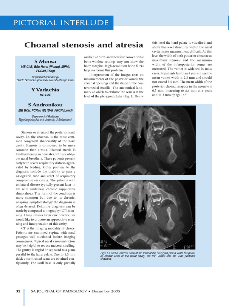 Choanal Stenosis and Atresia | PDF | Ct Scan | Radiology