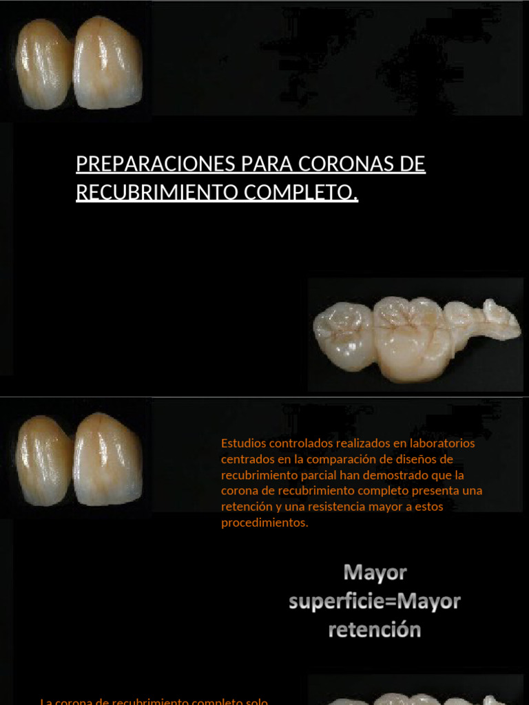 Preparación de Coronas Dentales Completa | PDF