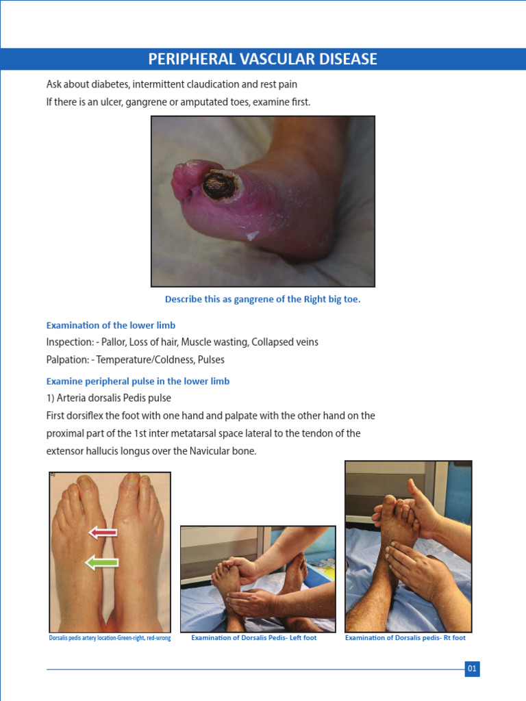 PERIPHERAL VASCULAR DISEASE | PDF | Human Leg | Foot
