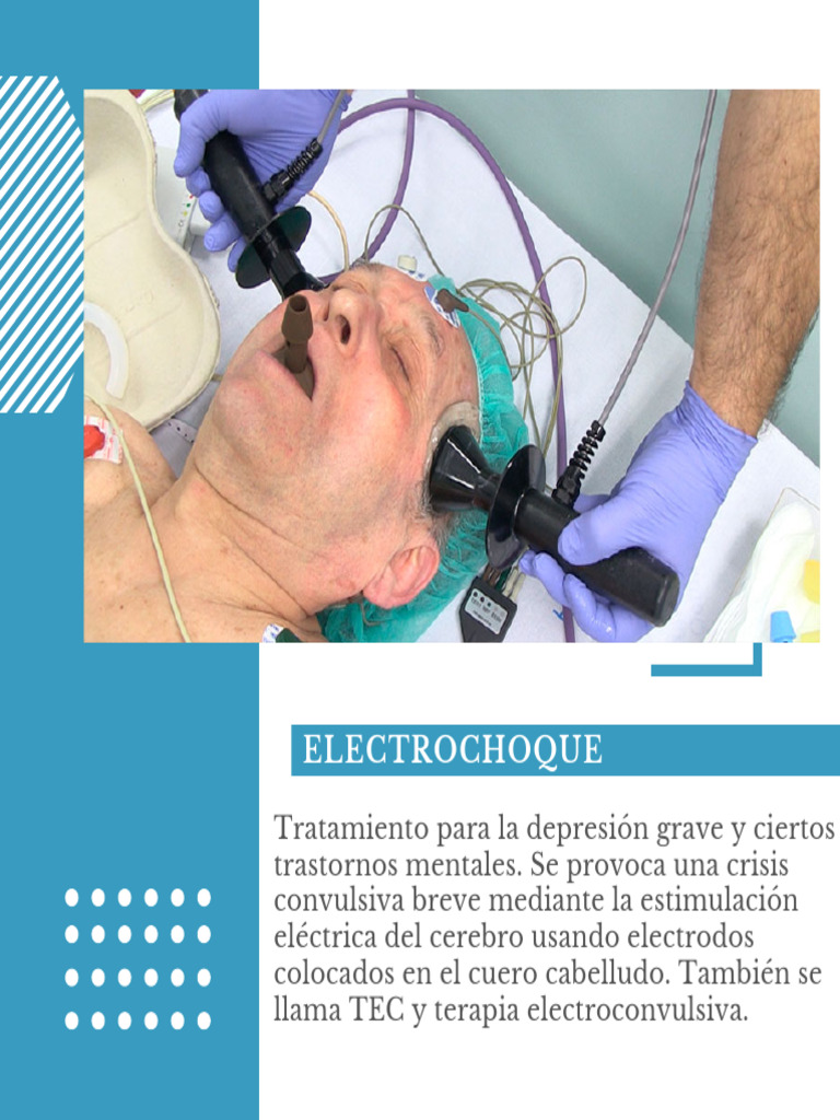 Terapia Electroconvulsiva para Depresión | PDF