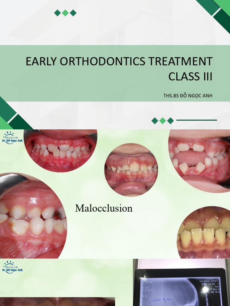 CLASS III TREATMENT (Đã Chỉnh) | PDF | Dentistry Branches | Orthodontics