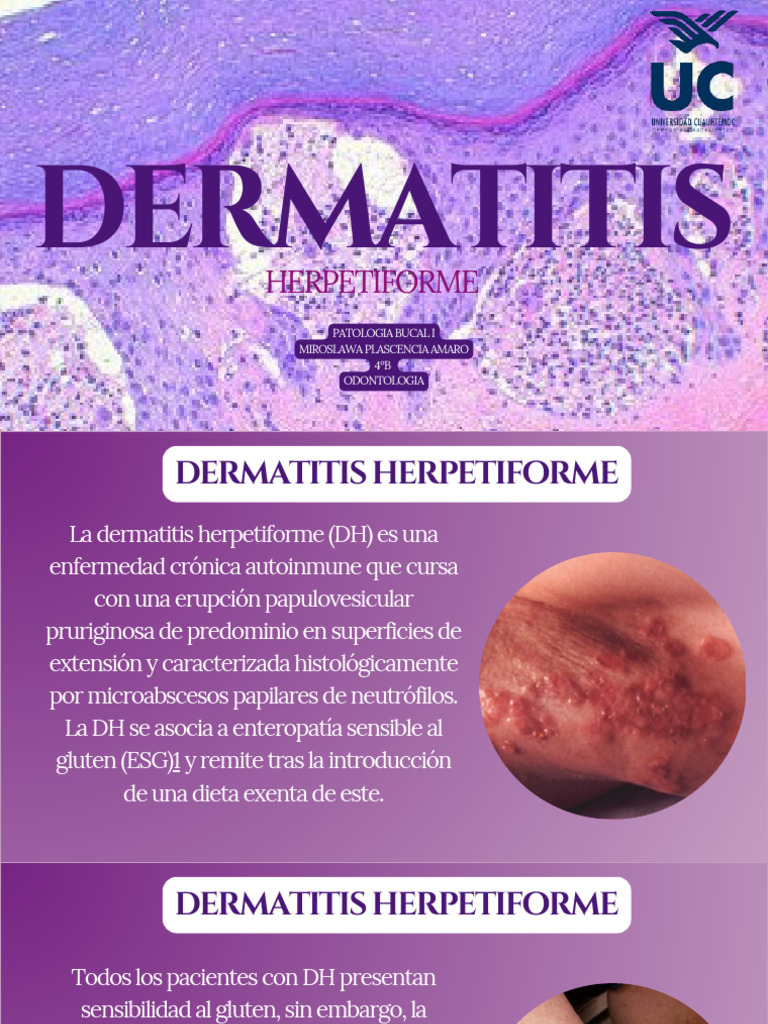 Dermatitis Herpetiforme PDF | PDF | Condiciones cutáneas | Inmunología