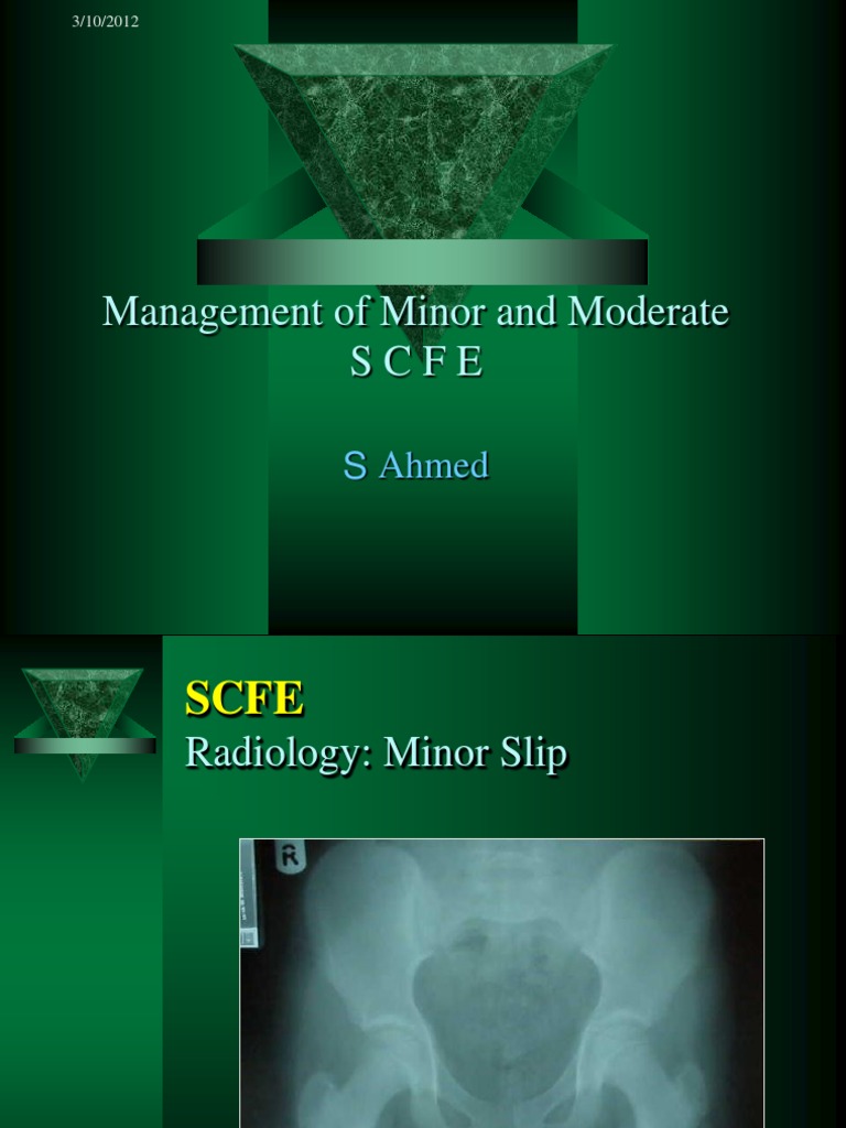 Management of Minor and Moderate Scfe: S Ahmed | PDF