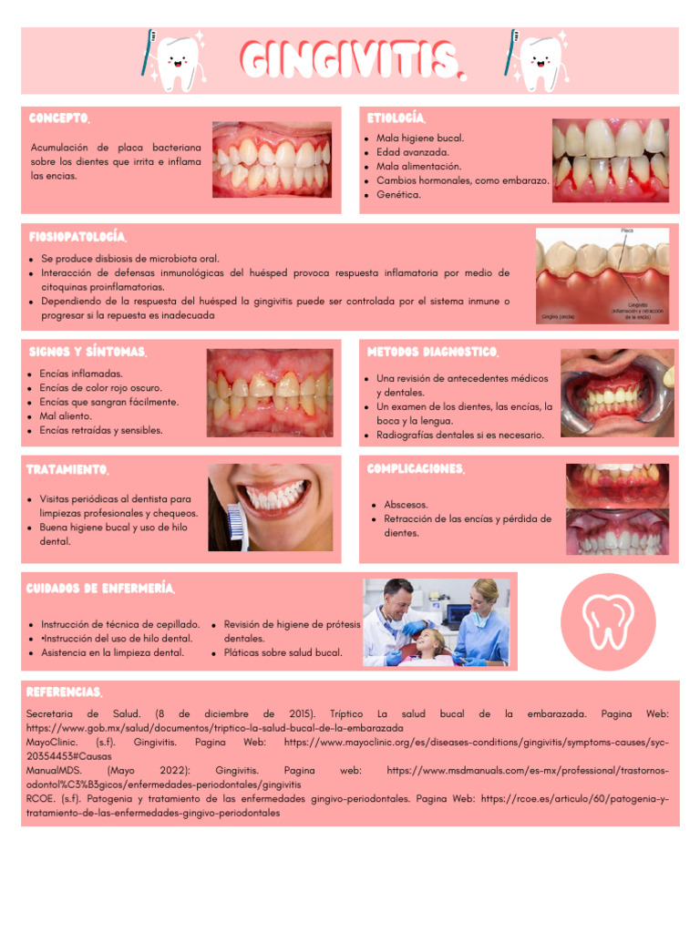 Gingivitis Infografia | PDF | Higiene oral | Especialidades Medicas