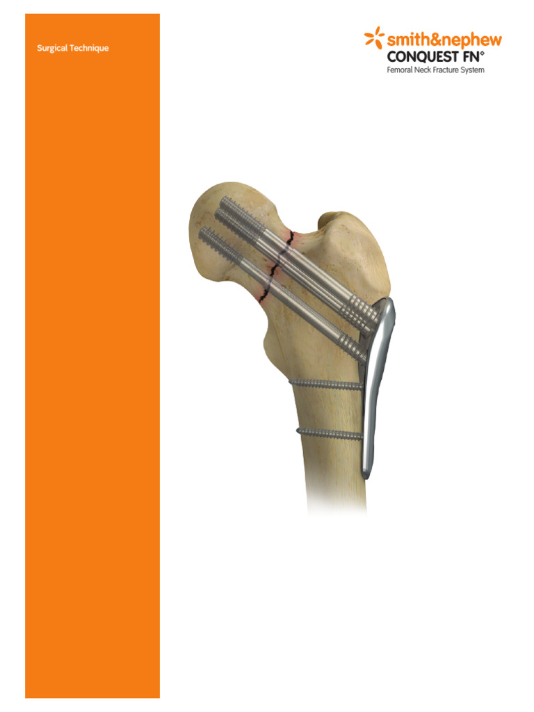 v4 71182200 Revc Conquest FN Surgical Technique 0120 | PDF | Screw | Drill