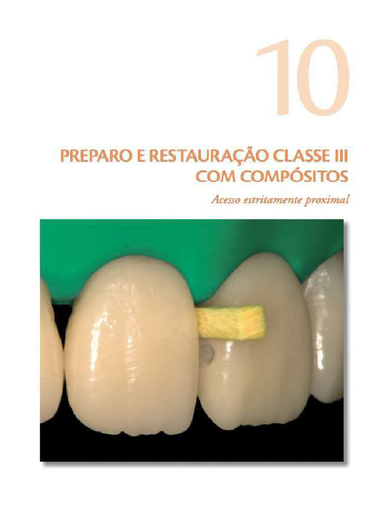 Preparo Cavitário III, IV e V | PDF