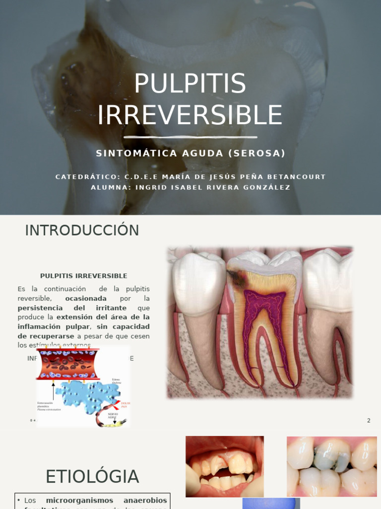 PULPITIS IRREVERSIBLE | PDF | Dolor | Especialidades Medicas
