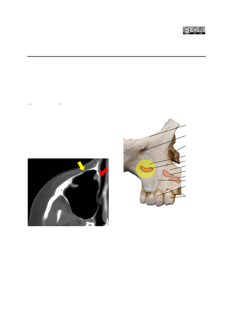 Caldwell-Luc Antrostomy Overview | PDF | Human Nose | Otorhinolaryngology