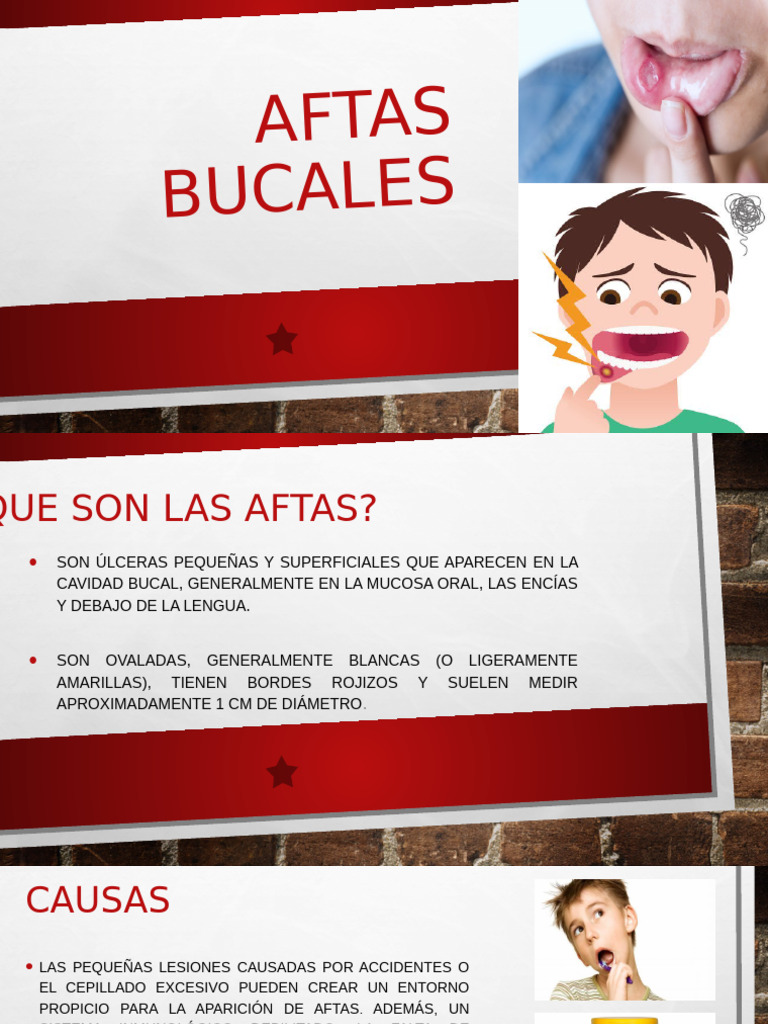 Aftas Bucales: Causas, Síntomas y Tratamiento | PDF | Especialidades ...