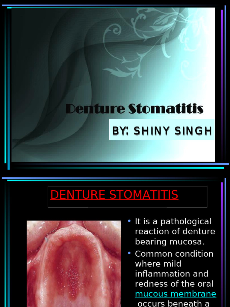Denture stomatitis | PDF