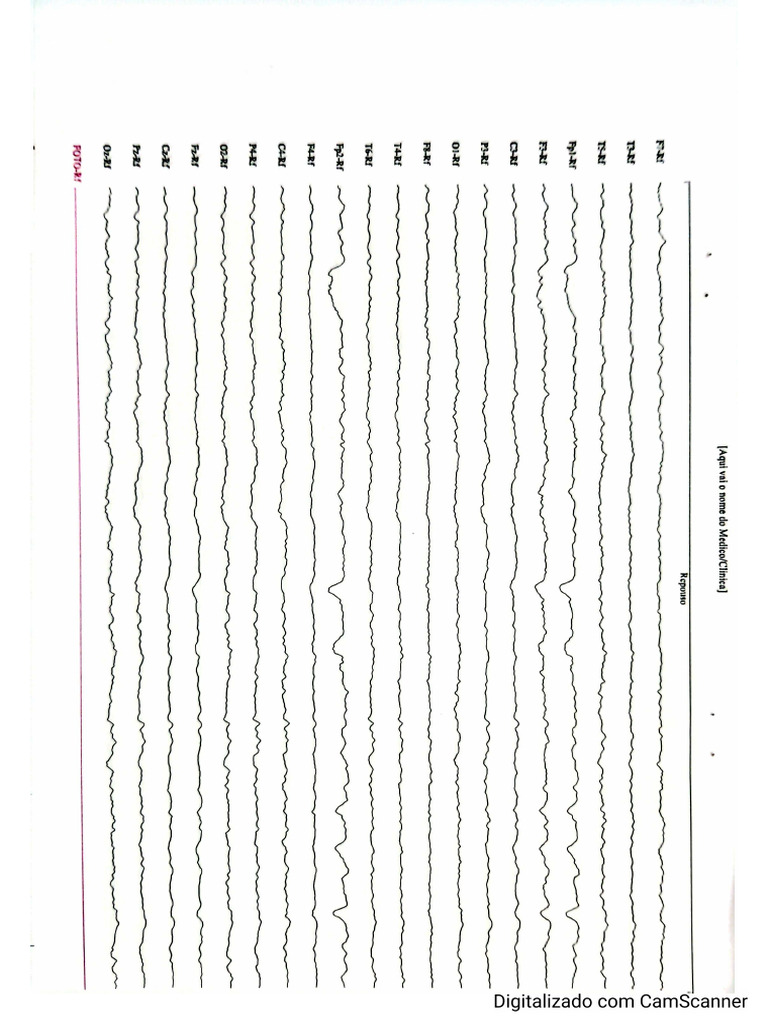 Atividade Epileptiforme no EEG | PDF