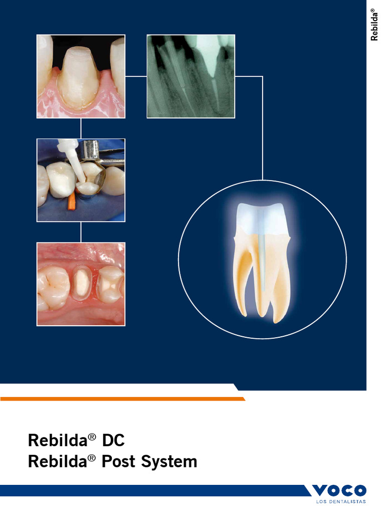 Rebilda DC Post System - Fol - Es | PDF | Polimerización | Materiales